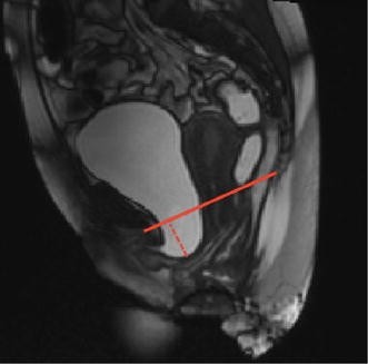 Magnetic Resonance Imaging of Female Pelvic Floor Dysfunction: A Review ...