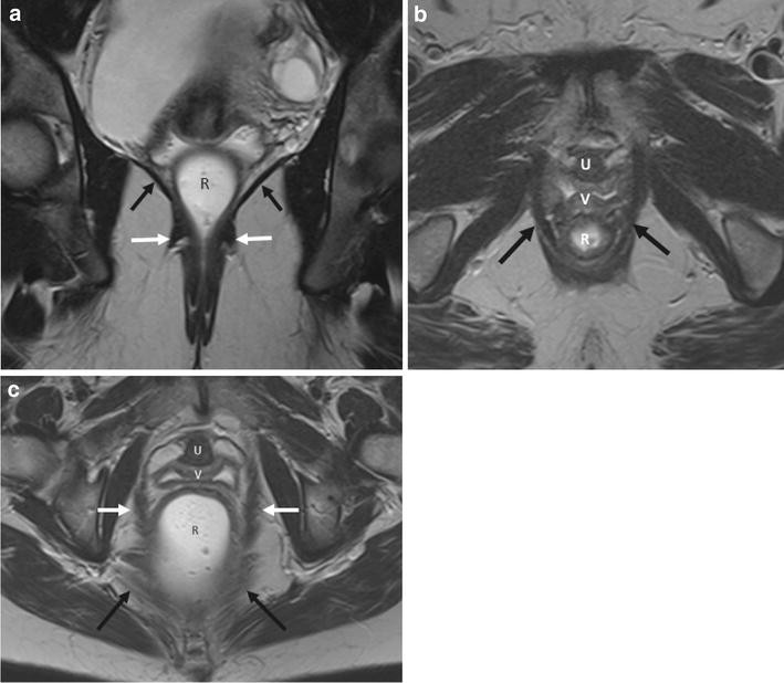 Magnetic Resonance Imaging of Female Pelvic Floor Dysfunction: A Review ...