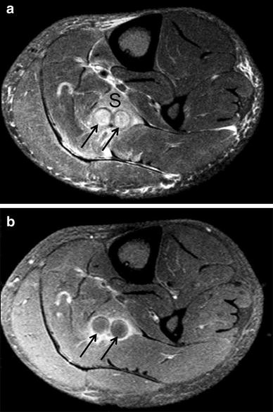 MRI of Sports Injuries in the Leg | SpringerLink