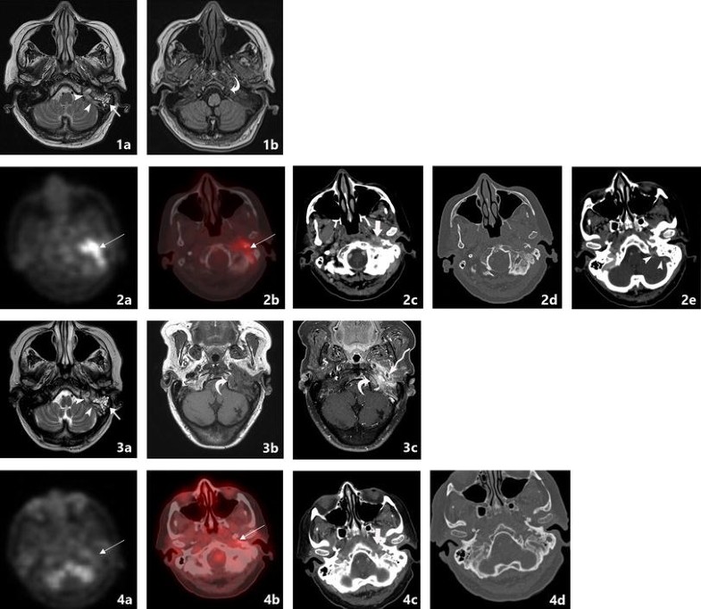 Advanced Imaging Techniques in Skull Base Osteomyelitis Due to ...