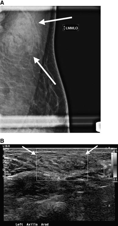 Imaging the Breast in Pregnant or Lactating Women | SpringerLink