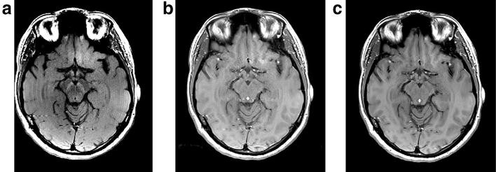 Imaging Parkinsonian Pathology in Substantia Nigra with MRI | SpringerLink