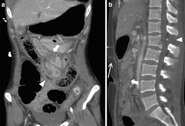 Blunt Injury of the Bowel and Mesentery | SpringerLink