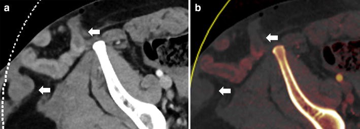 Blunt Injury of the Bowel and Mesentery | SpringerLink