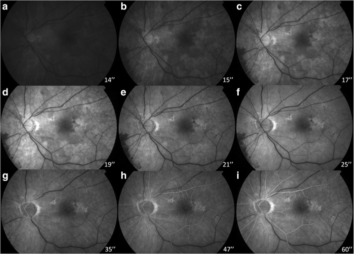 Central Retinal Artery Occlusion: Acute Management and Treatment ...
