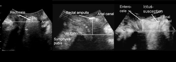 Pelvic Floor Ultrasound | SpringerLink