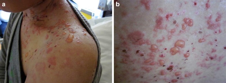 Bullous Systemic Lupus Erythematosus: A Review and Update to Diagnosis ...