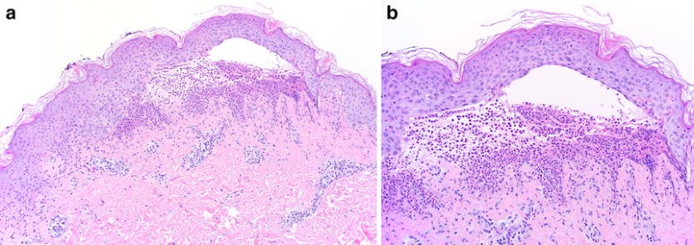 Bullous Systemic Lupus Erythematosus: A Review and Update to Diagnosis ...