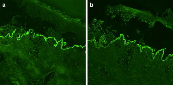 Bullous Systemic Lupus Erythematosus: A Review and Update to Diagnosis ...