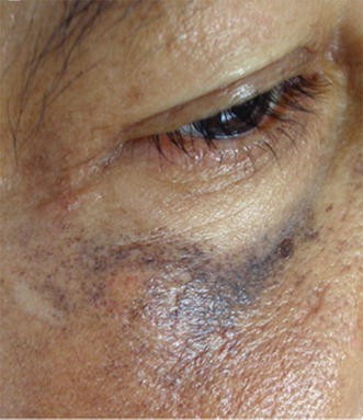 Exogenous Ochronosis: A Comprehensive Review of the Diagnosis ...