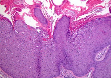 Immunostaining for High-Risk Human Papillomavirus in Condyloma Lesions ...