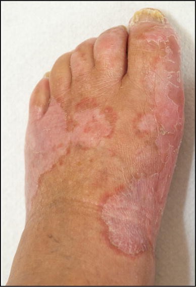 Cutaneous Manifestations of Diabetes Mellitus: A Review | SpringerLink