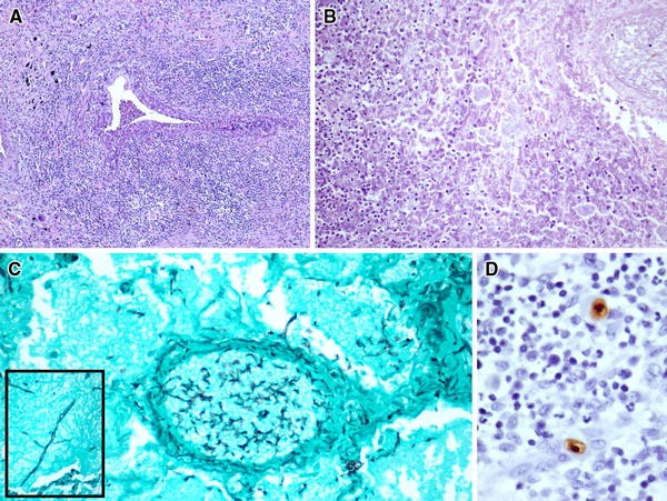 Mucor Infection: Difficult Diagnosis | SpringerLink