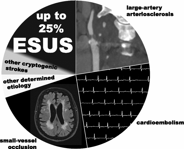 Management of Embolic Stroke of Undetermined Source (ESUS) | SpringerLink