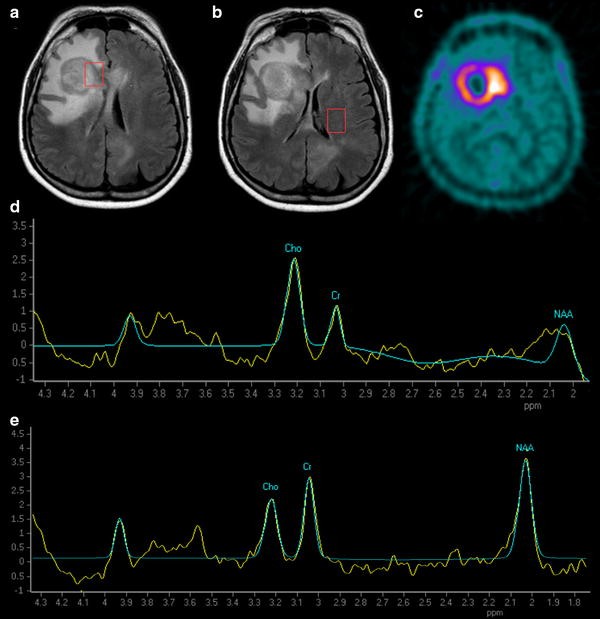 Positron emission tomography and magnetic resonance spectroscopy in ...