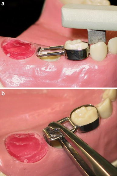 Optimal fit of chairside-fabricated distal shoe space maintainer ...