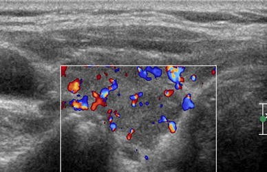 Ultrasound in sialadenitis | SpringerLink