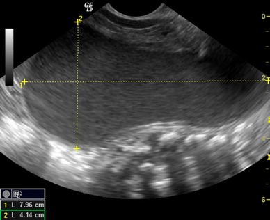 Imperforate hymen causing congenital hydrometrocolpos | SpringerLink