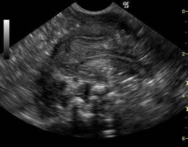 Imperforate hymen causing congenital hydrometrocolpos | SpringerLink