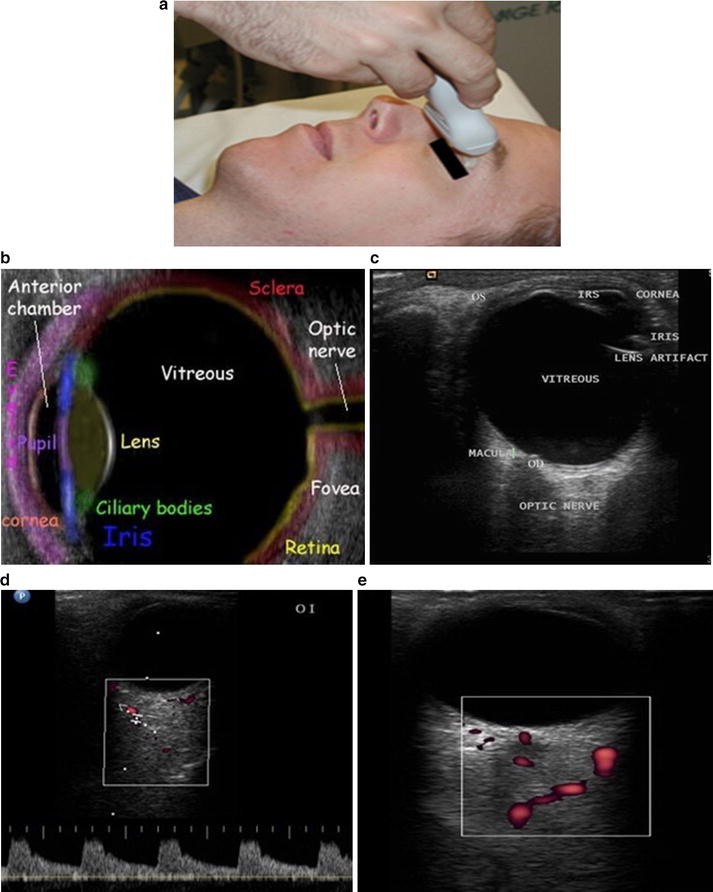 Role of B-scan ocular ultrasound as an adjuvant for the clinical ...