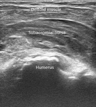 Prevalence of subacromial-subdeltoid bursitis in shoulder pain: an ...