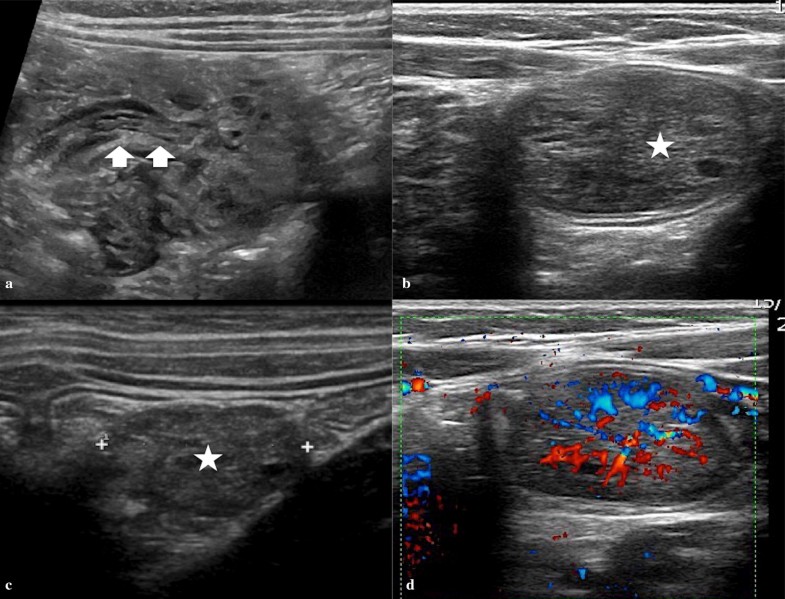 The pediatric gastrointestinal tract: ultrasound findings in acute ...
