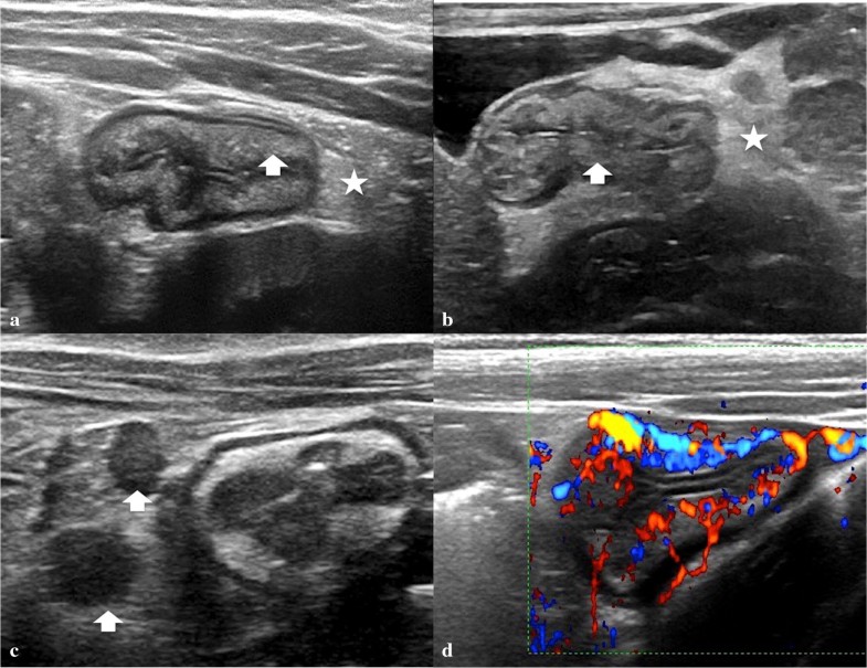 The pediatric gastrointestinal tract: ultrasound findings in acute ...
