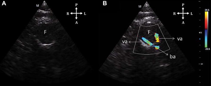 Transcranial Doppler ultrasound in neurocritical care | SpringerLink