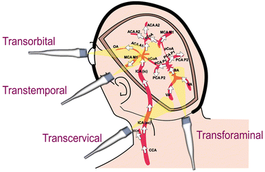 Transcranial Doppler ultrasound in neurocritical care | SpringerLink