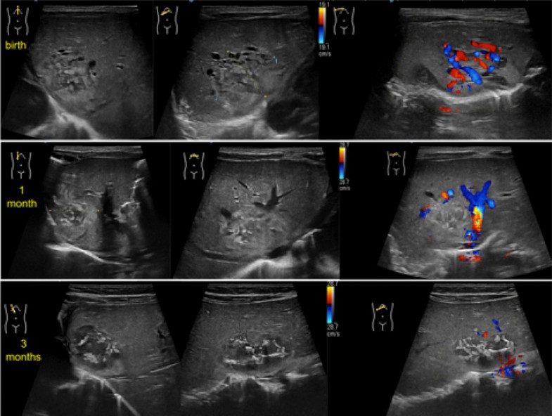 Paediatric liver ultrasound: a pictorial essay | SpringerLink