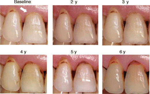 Root Caries Management: Evidence and Consensus Based Report | SpringerLink