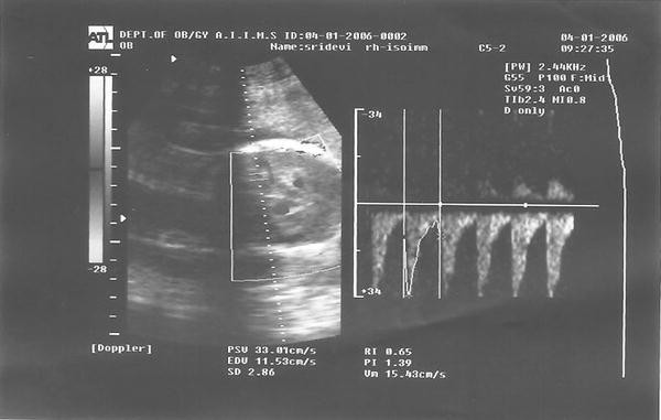 Intrauterine Transfusion | SpringerLink