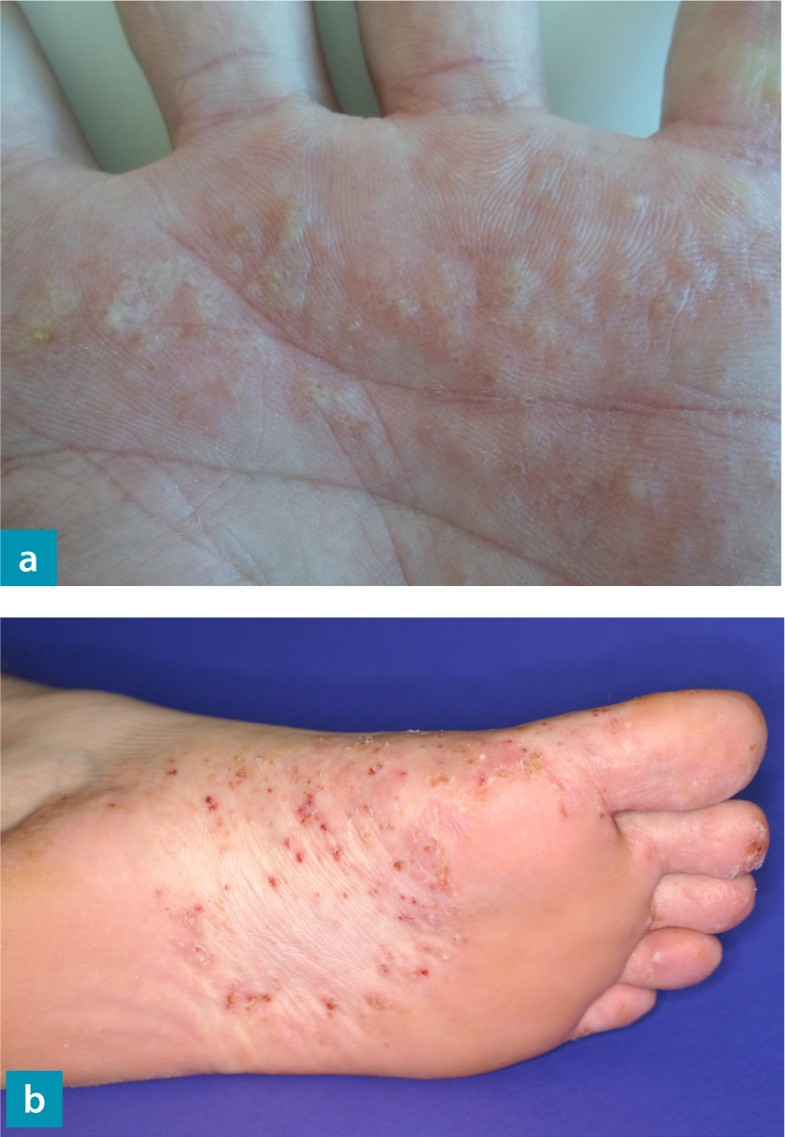 Dermatitis update: clinical manifestations, pathogenesis and current ...