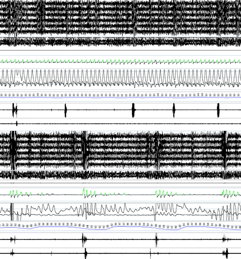 Periodic Limb Movement Disorder: a Clinical Update | SpringerLink