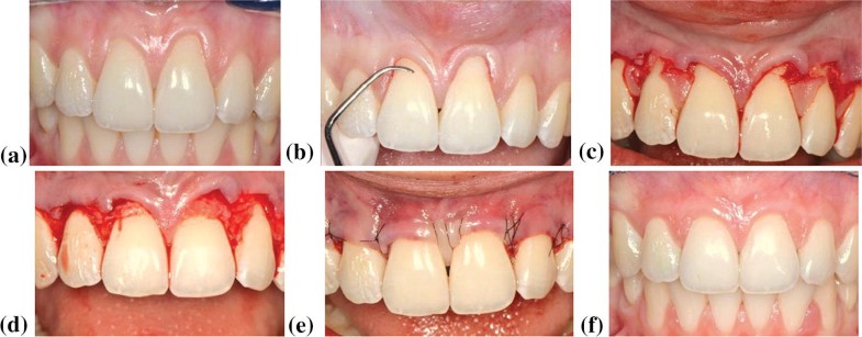 Surgical management of gingival recession using autogenous soft tissue ...