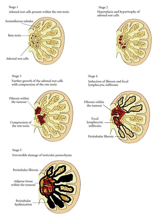 Testicular Adrenal Rest Tumours In Congenital Adrenal Hyperplasia