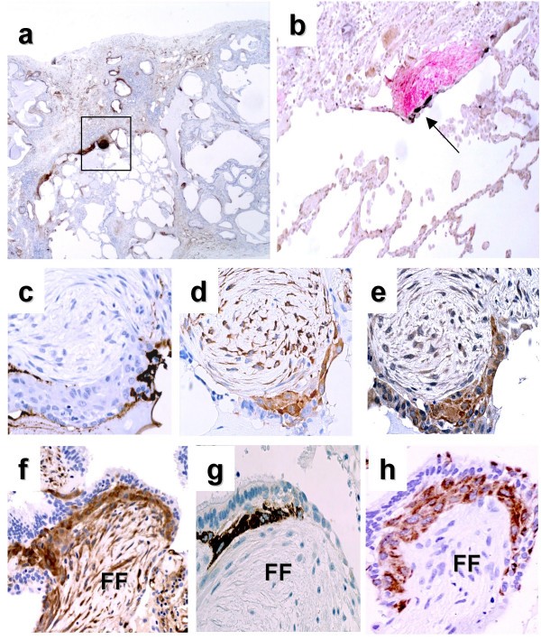 Migratory marker expression in fibroblast foci of idiopathic pulmonary ...