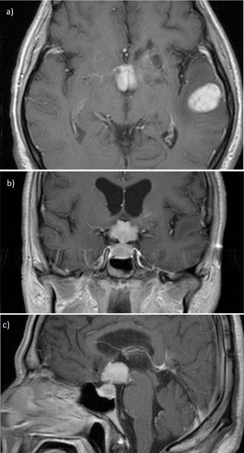 MR imaging features of intracranial primary CNS lymphoma in immune ...