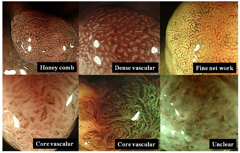 Correlation between magnifying narrow band imaging and histopathology ...