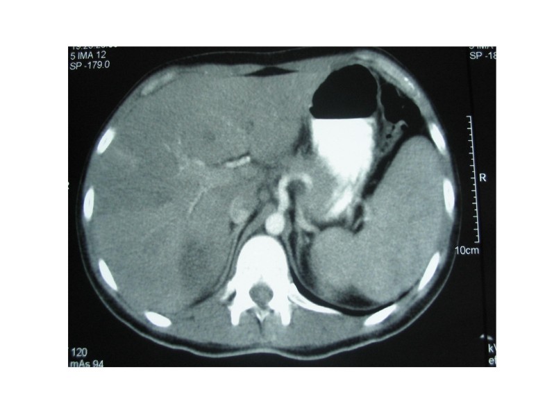 Septic thrombophlebitis of the superior mesenteric vein and multiple ...
