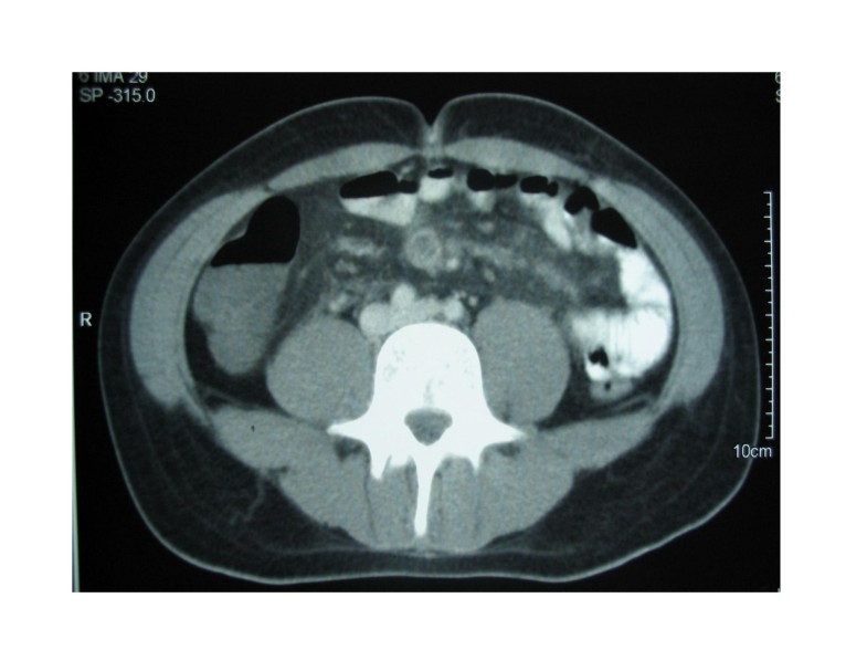 Septic thrombophlebitis of the superior mesenteric vein and multiple ...