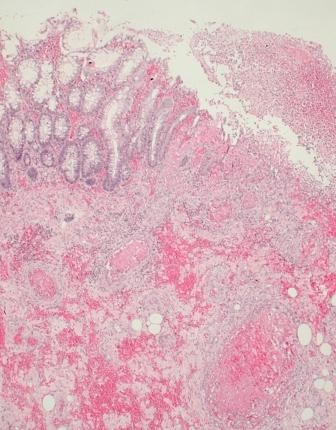 Phlegmonous colitis: another source of sepsis in cirrhotic patients ...