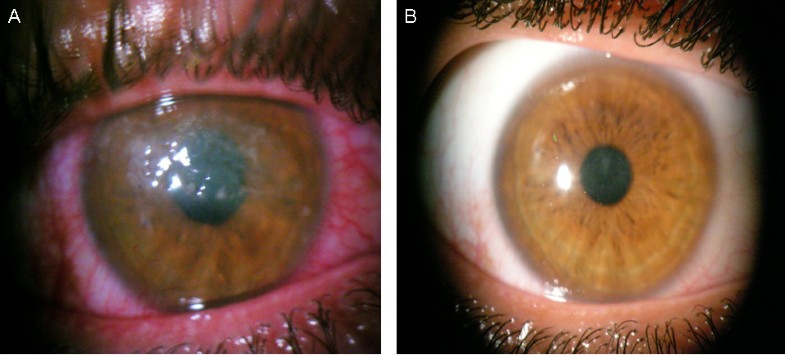 Nocardia transvalensis keratitis: an emerging pathology among travelers ...