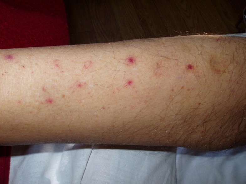 Outcome of acute East African trypanosomiasis in a Polish traveller ...