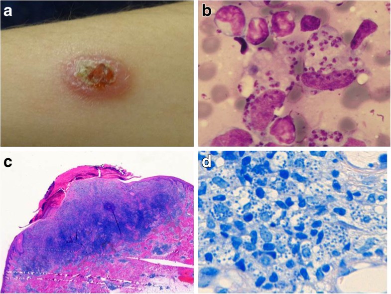 Non-healing old world cutaneous leishmaniasis caused by L. infantumin a ...
