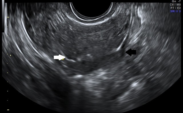 Hysterosalpingocontrast sonography (HyCoSy): evaluation of the pain ...