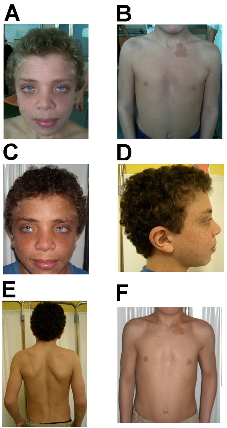 LEOPARD syndrome: clinical dilemmas in differential diagnosis of ...
