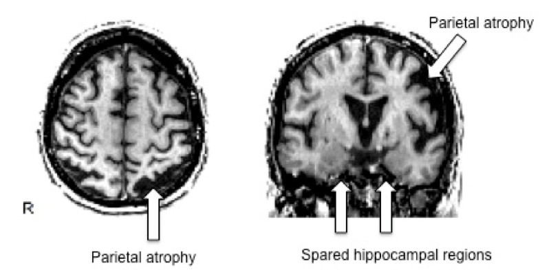 Visual neglect in posterior cortical atrophy | BMC Neurology | Full Text