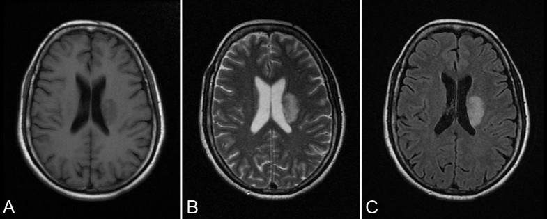 Early detection of secondary damage in ipsilateral thalamus after acute ...