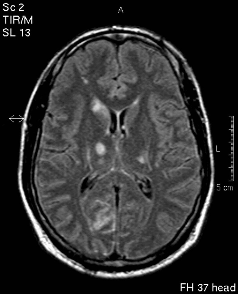 Primary angiitis of the central nervous system presenting with subacute and fatal course of ...